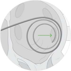 ProTrack™ Pigtail Wire - Corpmedical