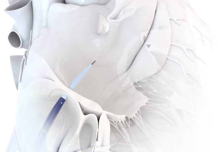 TorFlex™ Transseptal Guiding Sheath - Corpmedical