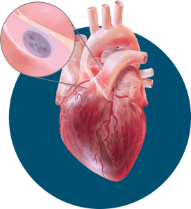 Abbott - AMPLATZER™ ASD - Corpmedical