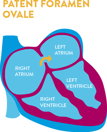 Abbott - AMPLATZER™ PFO - Corpmedical