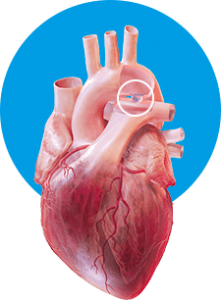 Abbott - AMPLATZER™ PDA - Corpmedical