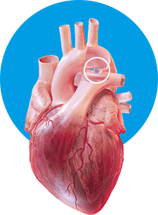 Abbott - AMPLATZER™ PDA - Corpmedical