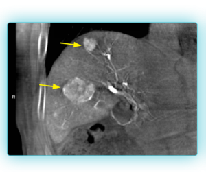 DC BeadLUMI™ - Corpmedical