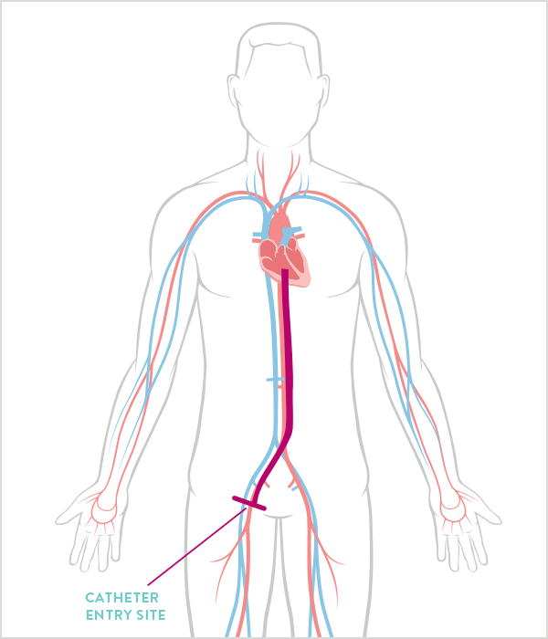 Abbott - AMPLATZER™ AMULET™ - Corpmedical