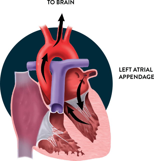 Abbott - AMPLATZER™ AMULET™ - Corpmedical